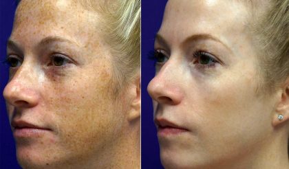 Contour TRL Laser Resurfacing Marin County | Plastic Surgery Specialists